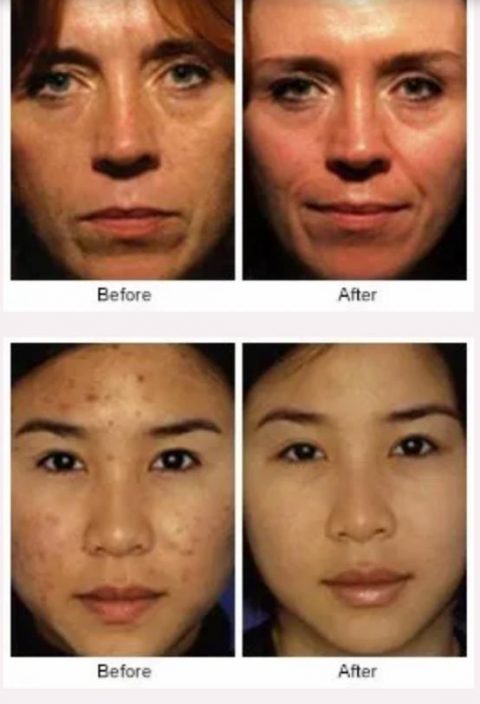 Hyperpigmentation, Uneven skin tone | Brighton & Hove Cosmetic Clinic